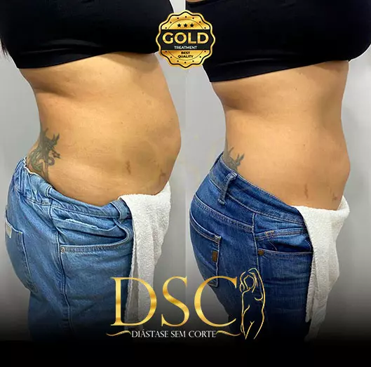 Curso DSC - Diástase Sem Corte | Método Stark